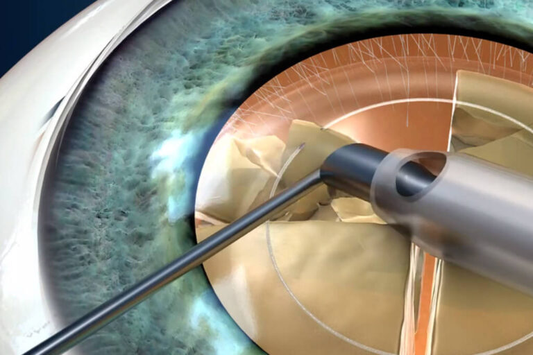Cataract Phaco Surgery Overview - RETINA & EYECARE CENTRE