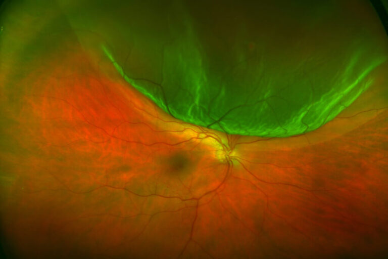 Retinal Detachment - RETINA & EYECARE CENTRE