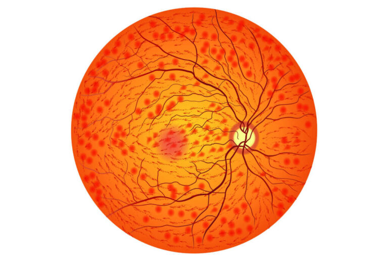 Central Retinal Vein Occlusion (CRVO) - RETINA & EYECARE CENTRE